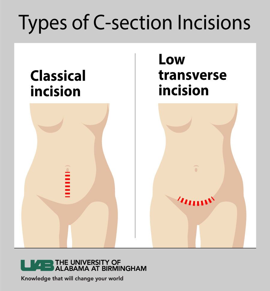 c section incision care
